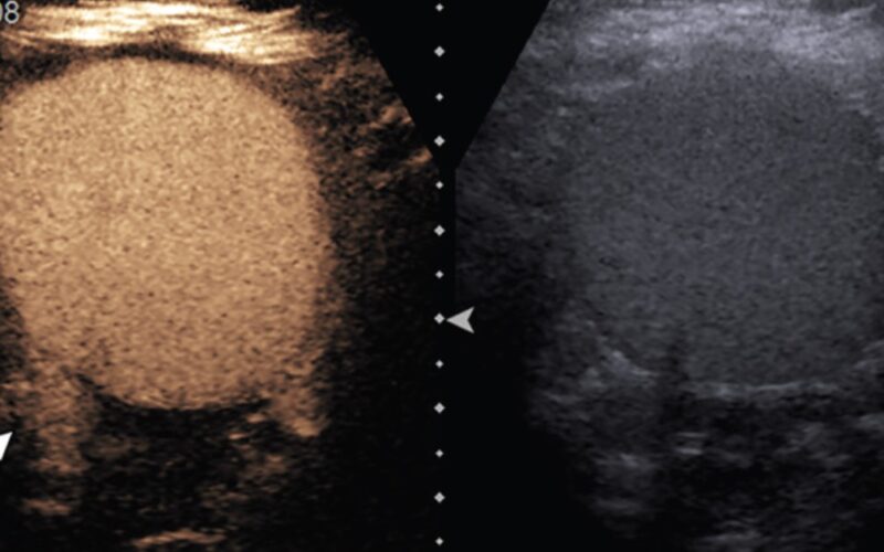 Ultrazvučna kontrastna mikciona urografija - cistografija | Ultrazvučna ...