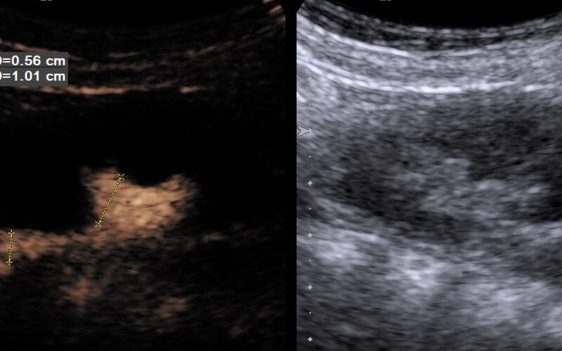 Ultrazvučna kontrastna mikciona urografija - cistografija | Ultrazvučna ...