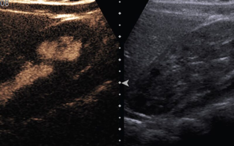 Ultrazvučna kontrastna mikciona urografija - cistografija | Ultrazvučna ...