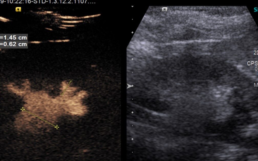 Ultrazvučna kontrastna mikciona urografija - cistografija | Ultrazvučna ...