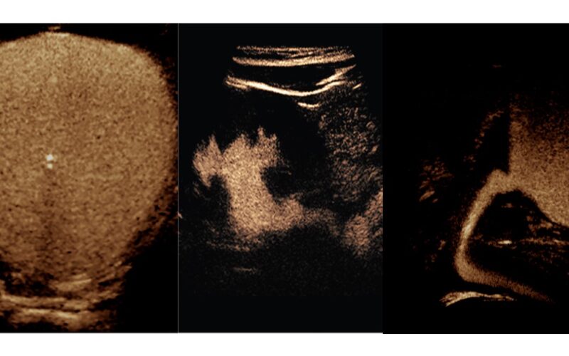 Ultrazvučna kontrastna mikciona urografija - cistografija | Ultrazvučna ...